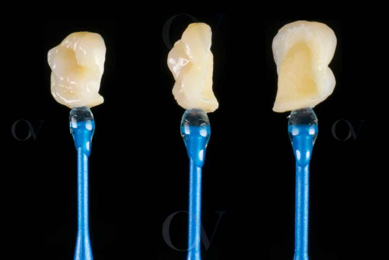 ᐈ Incrustación Dental: inlay, onlay y overlay 🥇🥇