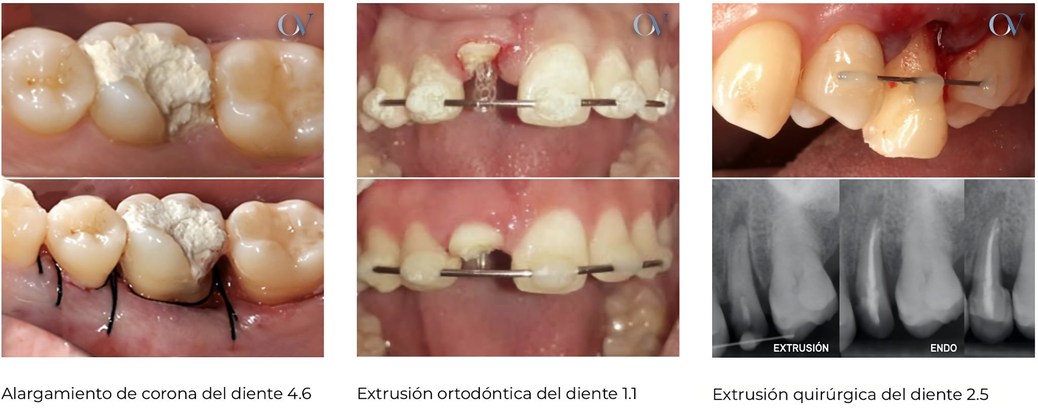 ᐈ El Ferrule dental o efecto ferrule ⭐