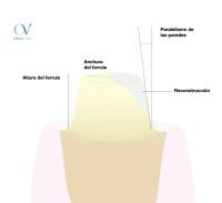 ᐈ El Ferrule dental o efecto ferrule ⭐