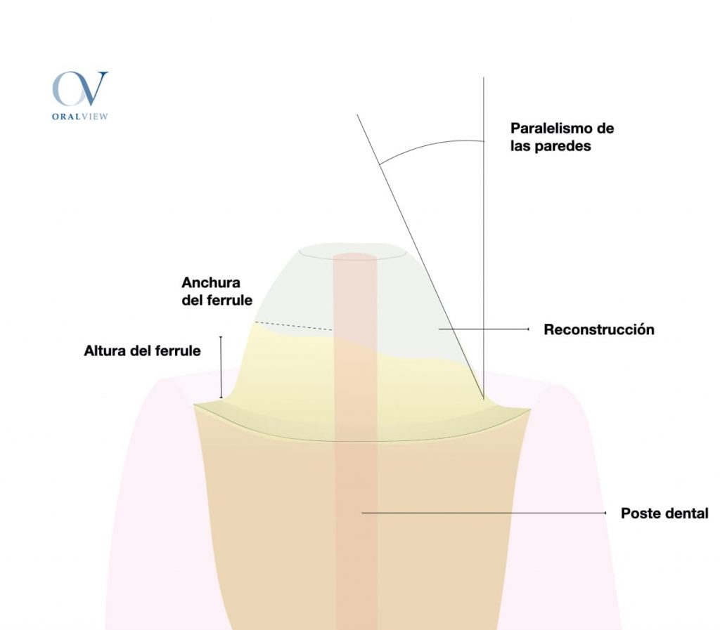 ᐈ El Ferrule dental o efecto ferrule ⭐