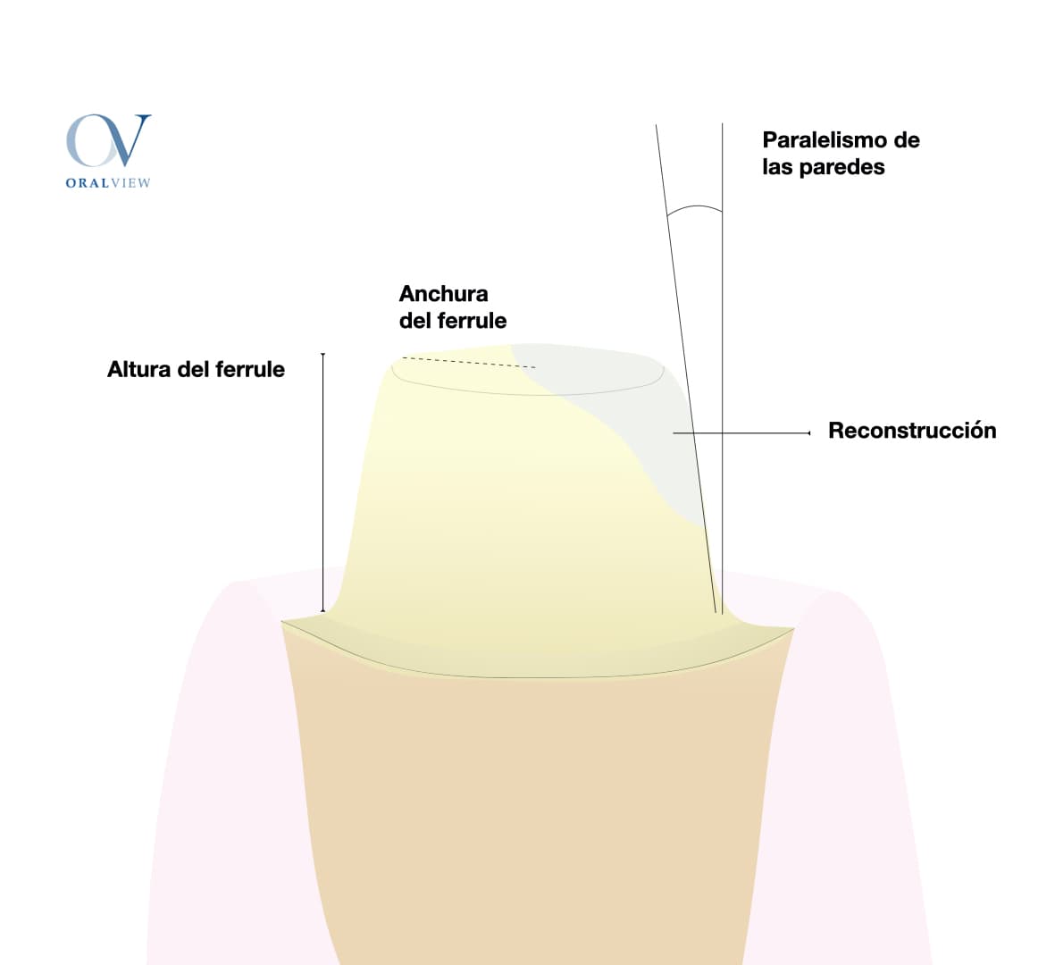 What Is Ferrule In Dentistry at Danyelle Welch blog