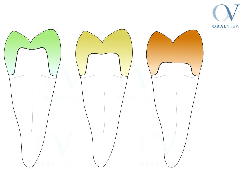 What Is Ferrule In Dentistry at Danyelle Welch blog