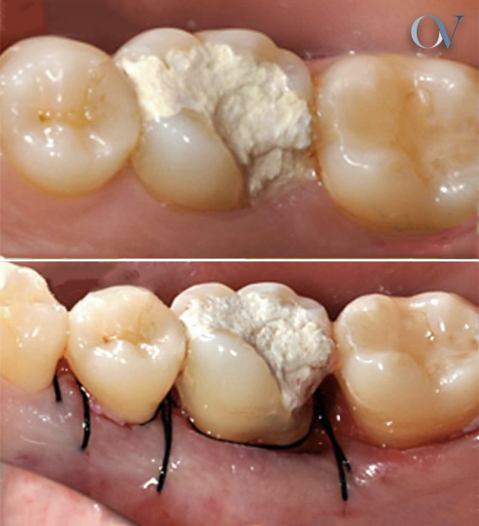 ᐈ El Ferrule dental o efecto ferrule ⭐