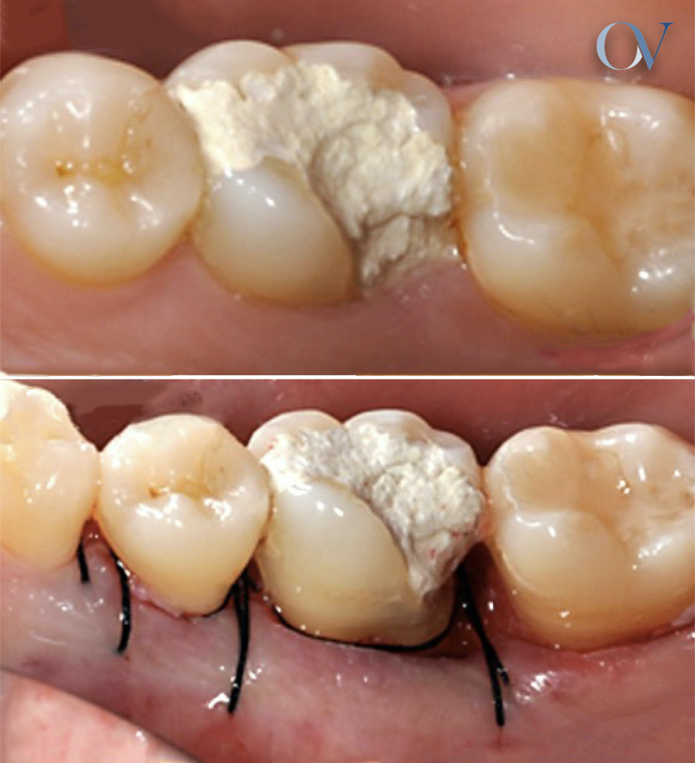 What Is Dental Ferrule at Debra Helton blog