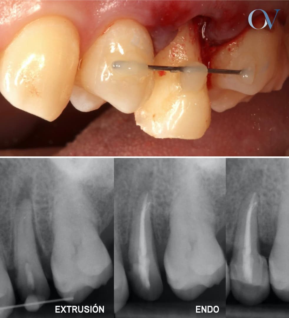 What Is Dental Ferrule at Debra Helton blog