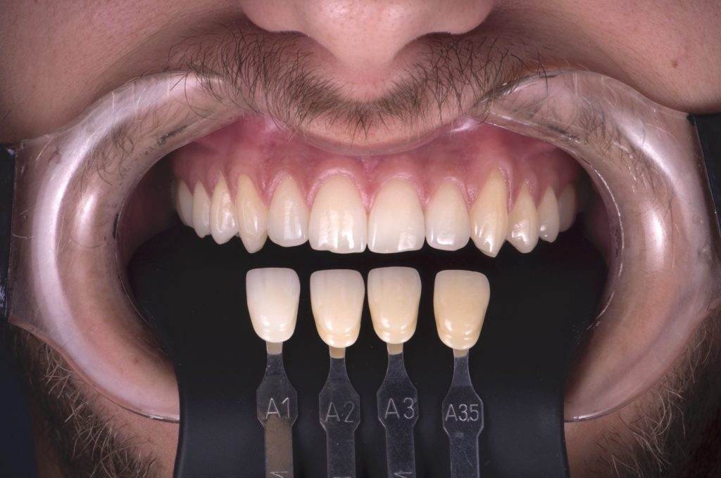 ᐈ La fotografía dental explicada - 📷